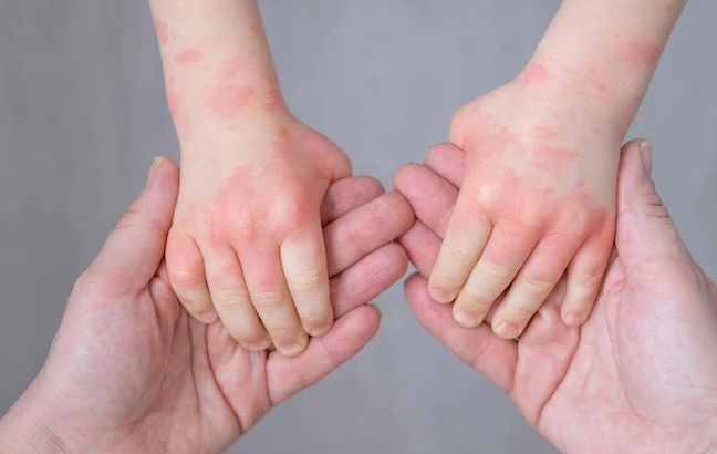 Waspadai Gejala Alergi, Kenali Pemicunya dan Lindungi Diri!